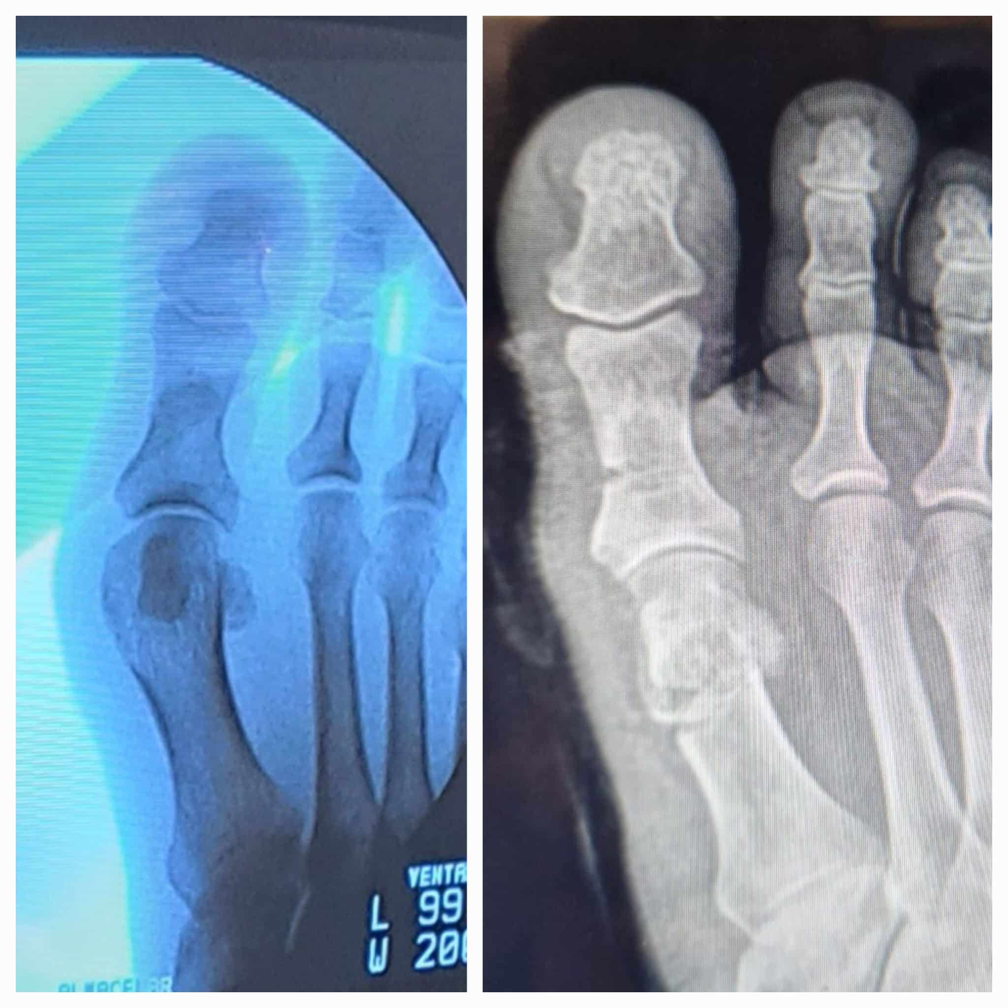 Cirugía de Juanetes en Alicante: Cirugía Hallux Valgus